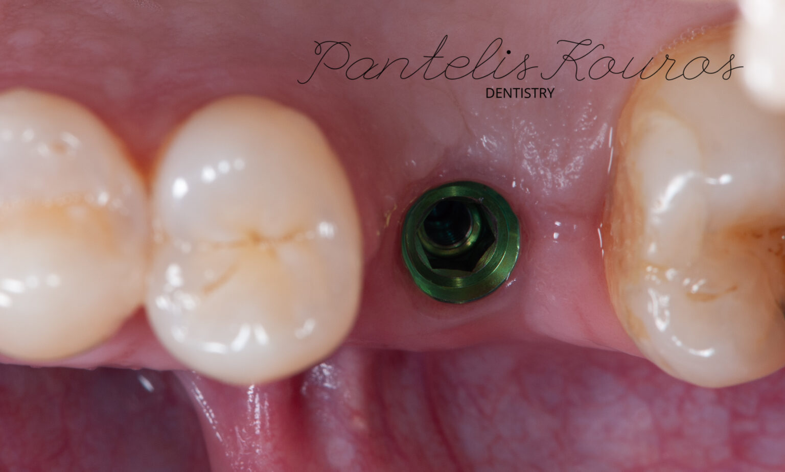 Εμφυτεύματα - Dental Services